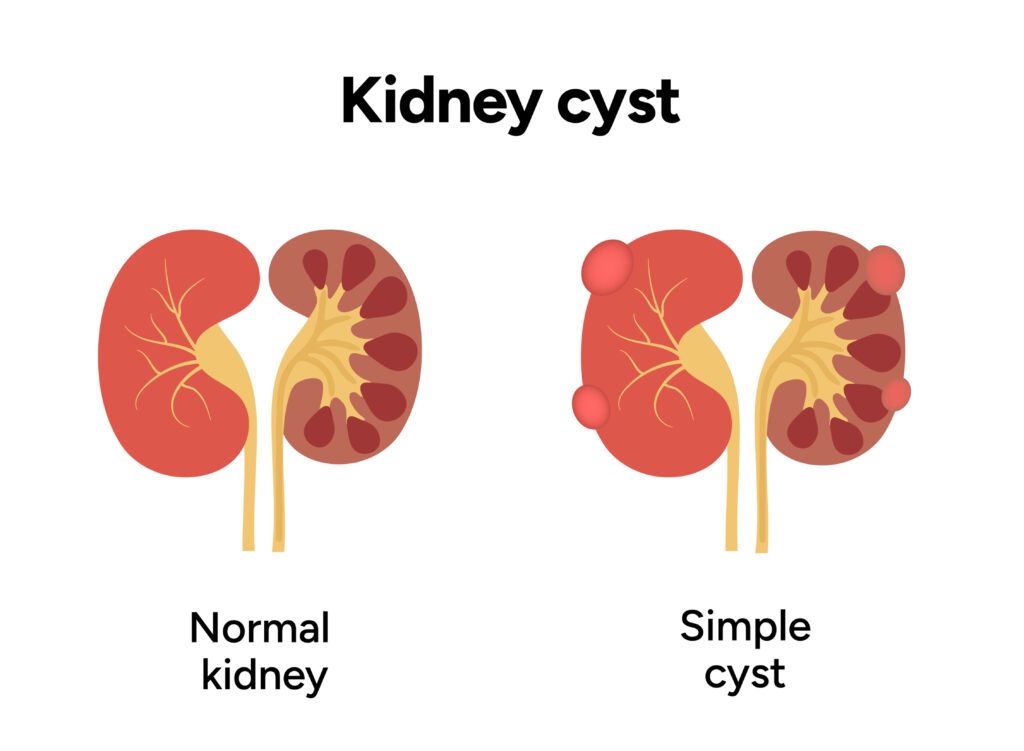 Kidney Cysts - Gold Standard Urology
